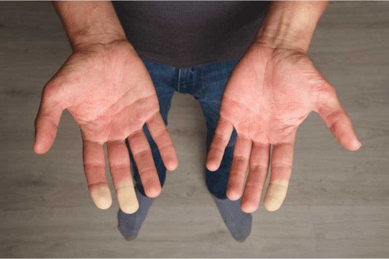 Raynaud's Disease: Why are my Hands and Feet Turning Purple? - Apex ...